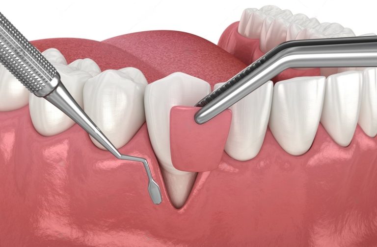 Everything You Need to Know About Gum Grafting and Soft Tissue Grafting ...