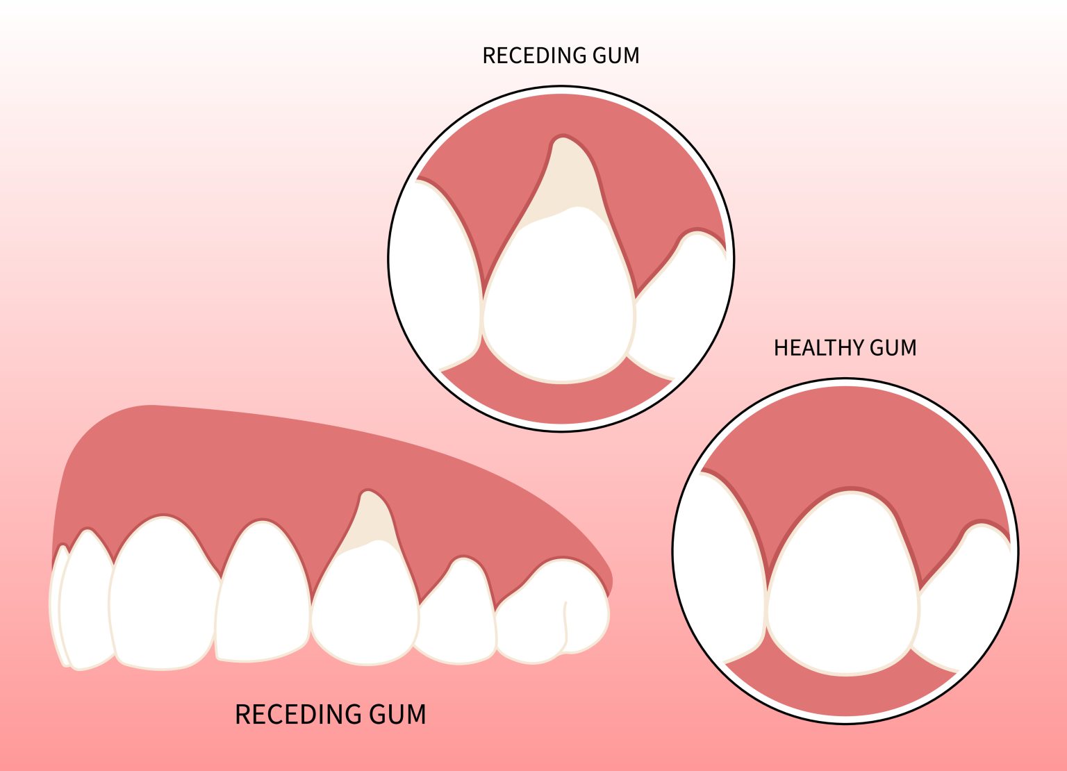 Everything You Need to Know About Connective Tissue Grafts for Receding ...